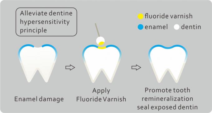 5% Sodium Fluoride Tooth Varnish Resin Based Pediatric Fluoride Varnish