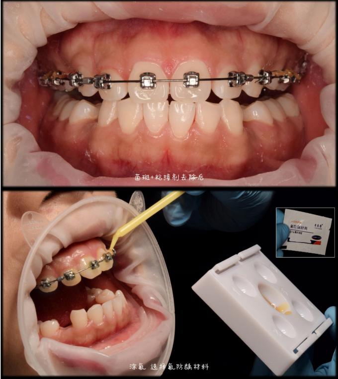 3mL 2 Tone Purple Red Plaque Indicator Liquid Staining Disclose Solution