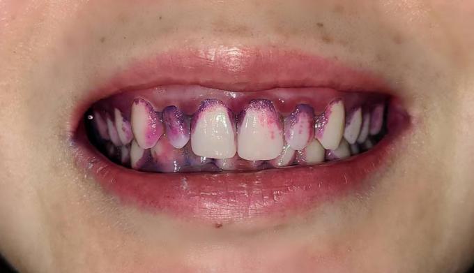 Grape Flavor Two Color Dental Plaque Indicator To Lock In Place Of ...